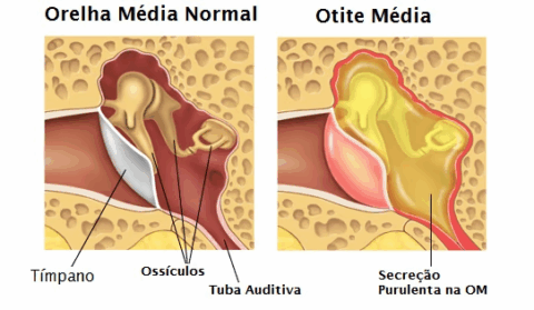 Ear Pain When Flying: Airplane Barotrauma | Dr. José Eduardo Marcondes
